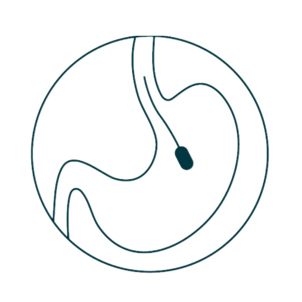 Allurion Gastric Balloon - Metabolic GI Surgery Brisbane